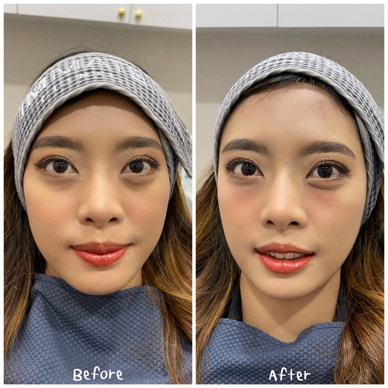 รีวิว ใต้ตาสดใสเหมือนอนครบ 8 ชม. ด้วย Meso eye ที่ IMMATE CLINIC ...