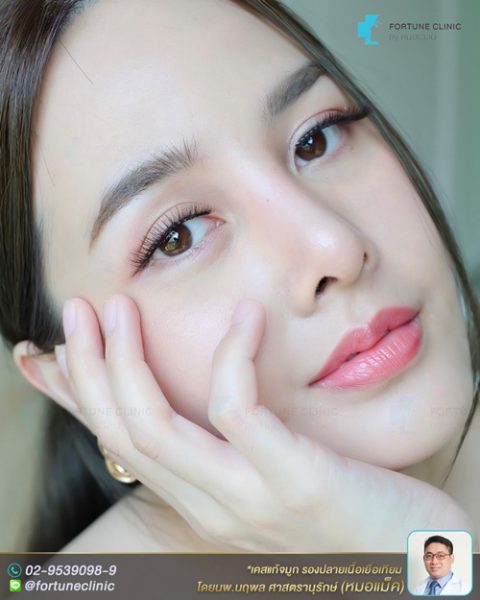 แชร์! คลินิกทำจมูกในไทยที่ไหนดี 2566 - Ladyissue เว็บรีวิวเครื่องสำอาง ชุมชนผู้หญิง ฮาวทู ...