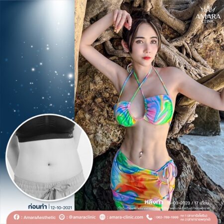 5 คลินิกดูดไขมันยอดฮิต 2566 ดูดไขมันที่ไหนดี?! - Ladyissue เว็บรีวิวเครื่องสำอาง ชุมชนผู้หญิง ฮา ...