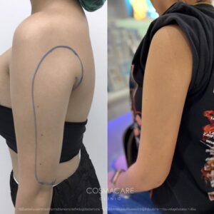 5 คลินิกดูดไขมันยอดฮิต 2566 ดูดไขมันที่ไหนดี?! - Ladyissue เว็บรีวิวเครื่องสำอาง ชุมชนผู้หญิง ฮา ...